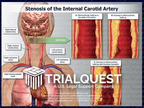 Progression Of Stenosis Internal Carotid Artery
