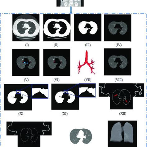 Lung Segmentation Process Diagram Download Scientific Diagram
