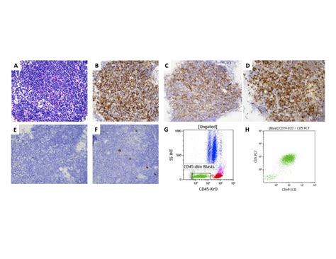 B Cell Lymphoblastic Leukemia With Aberrant Expression Of Cd5