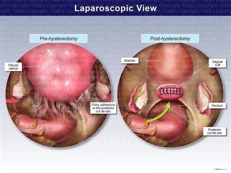 Laparoscopic View Trialquest Inc