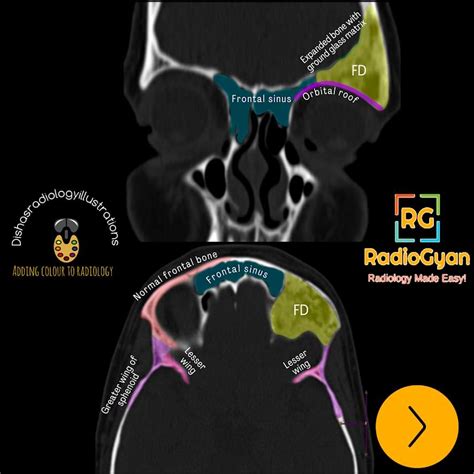 Fibrous Dysplasia Radiology Case
