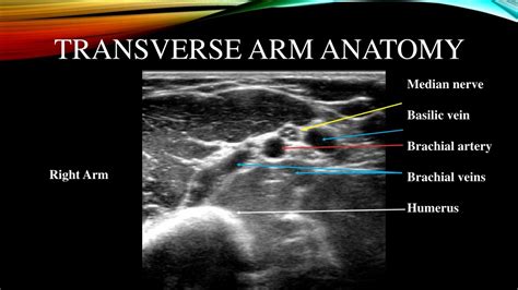 Ppt Mastering Peripheral Iv Access Techniques And Tips For Success