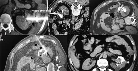 A D Computed Tomography Imaging In Axial Section Showing Wedge Shaped