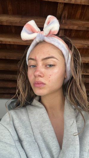 Leni Klums Pimple Face Of The Day