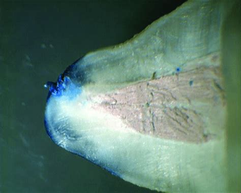 Apical Dye Leakage After The Step Back Technique And Filling With Download Scientific Diagram