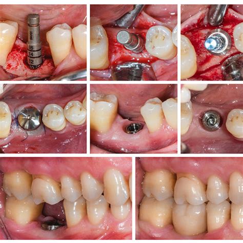 Xcem Dental Implant Submerged Healing Abutment 6mm