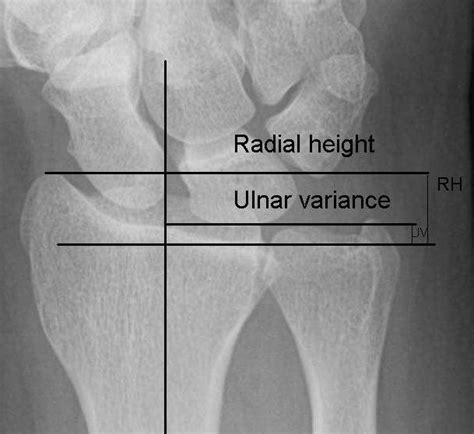 Ulnar Variance Definition Types Measurement And Clinical Relevance