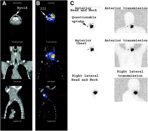Evaluation And Localization Of Lymphatic Drainage And Sentinel Lymph