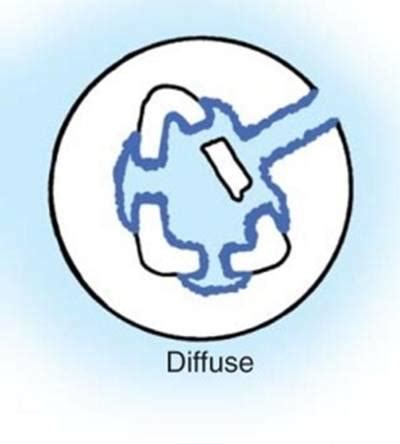 Osteomyelitis Adult Trauma Orthobullets