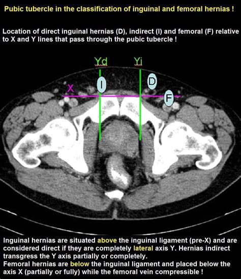 Pubic Tubercle In The Classification Of Inguinal And Femoral Hernias