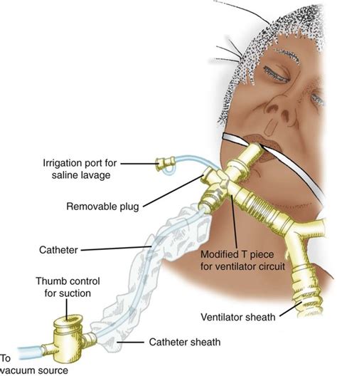 Airway Management Thoracic Key