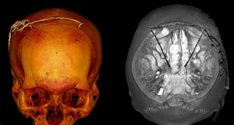 Three Dimensional Reconstruction Of Dbs Electrodes Using An Open Source Download Scientific