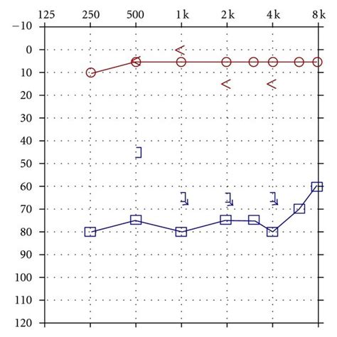 Abnormal Auditory Brainstem Response Waveform Morphology Consisting Of