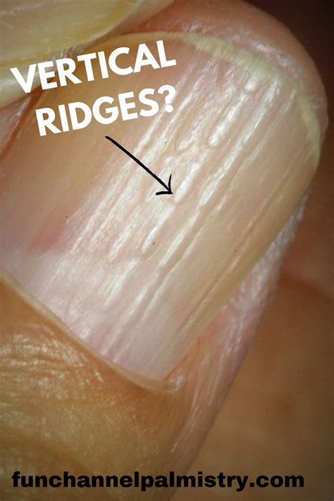 Do You Have These Vertical Ridges On Your Nails Palmistry Vertical