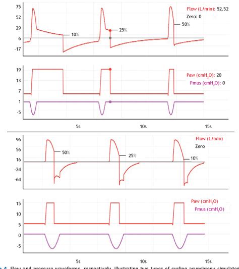 Figure 1 From Patient Ventilator Asynchrony Semantic Scholar Figure 1 From Patient Ventilator Asynchrony Semantic Scholar