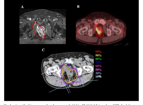 Figure 1 From Five Year Outcomes In Carbon Ion Radiotherapy For