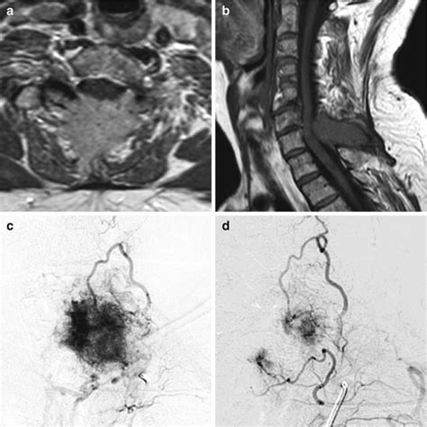 Ct X Ray Guided Techniques In Vertebral Tumors Embolization Neupsy Key