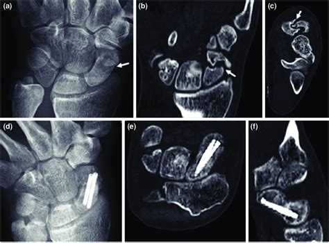 Case 13 A Preoperative Posteroanterior Radiograph Showing Scaphoid Download Scientific