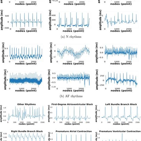 Sample Of Ecg Raw Data For A N B Af And C Non Af Rhythms From