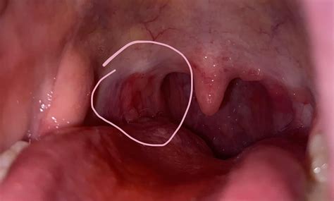6 Years Post Tonsillectomy R Tonsilstones