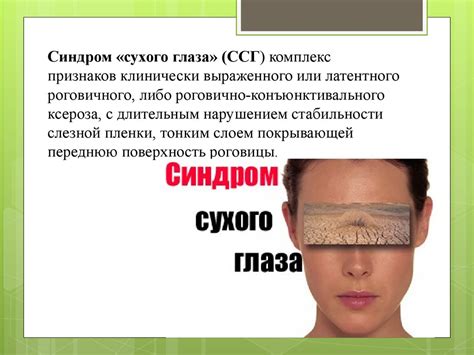 Синдром сухого глаза - презентация онлайн