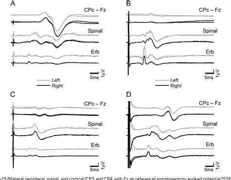 Figure 1 From Amplitudes Of Ssep And Outcome In Cardiac Arrest Survivors Semantic Scholar