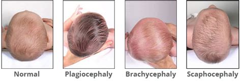 Flat Head Syndrome When To Worry And What To Do Growing Bones