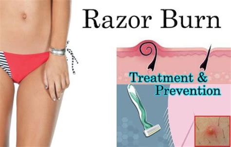 How To Prevent Razor Burn