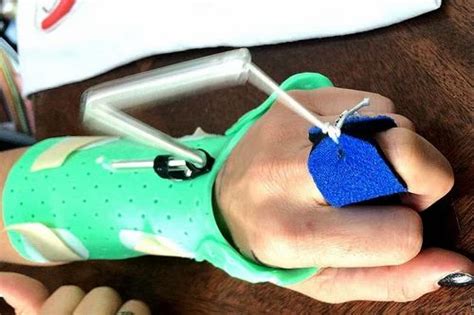 Lay3d Multicolor Low Temperature Thermoplastic Splint Material At ₹ 4000 In Coimbatore