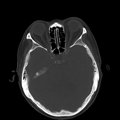 Hemangioblastoma Image