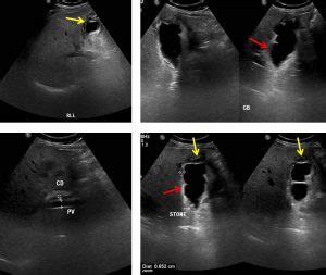 Ruptured Gallbladder Empyema Radiology Cases