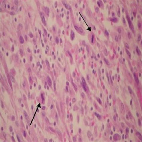 Pdf Synchronous Gist With Osteoclast Like Giant Cells And A Well