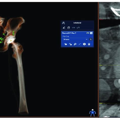 Preoperative Planning Of The Acetabular Cup Plasmafit Plus 7 With 3d