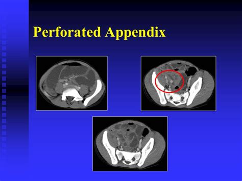 Infant Bowel Obstruction Ppt Video Online Download