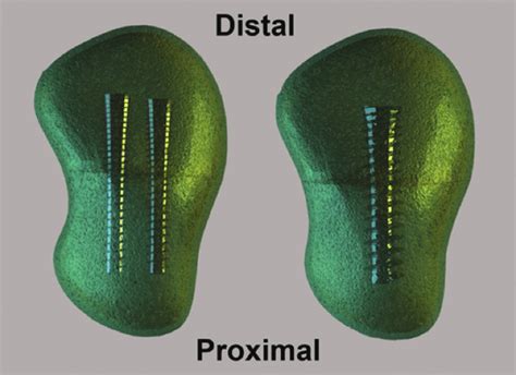 A Complete Transverse Scaphoid Fracture Herbert Classification Type