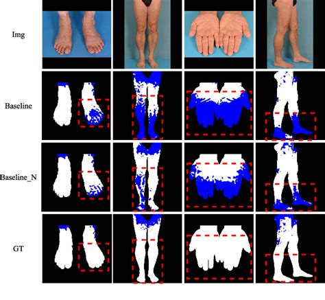 Figure 11 From Bridging The Gap Between Vitiligo Segmentation And Clinical Scores Semantic Scholar