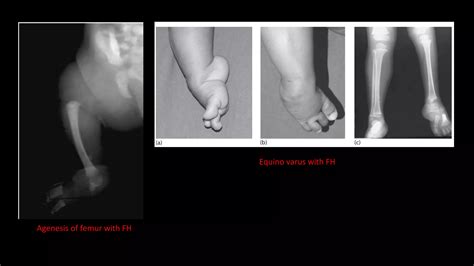 Fibular Hemimelia Ppt Free Download
