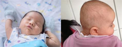 Kepala Bayi Peyang Segera Atasi Dengan Cara Ini