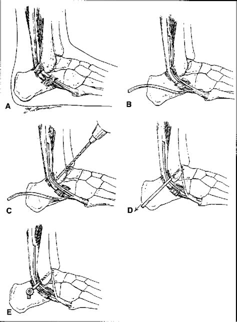 Figure 1 From Modification Of The Chrisman Snook Technique Semantic Scholar
