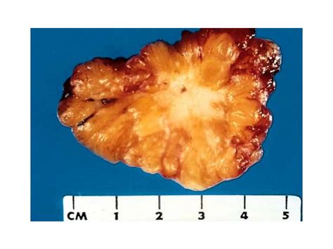 Basics And Epidemiology Of Neoplasiappt