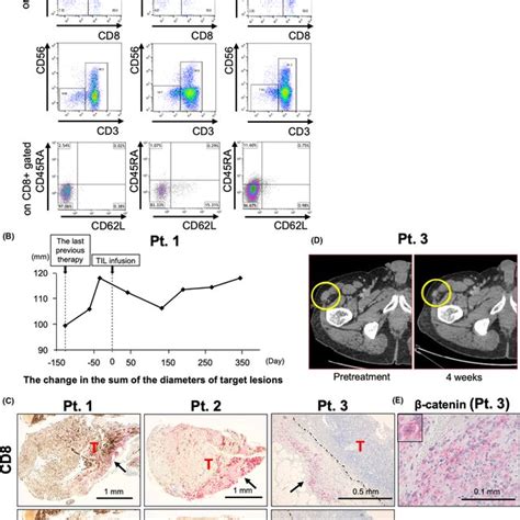 Protocol Of Adoptive Cell Therapy Act Using Tumor‐infiltrating