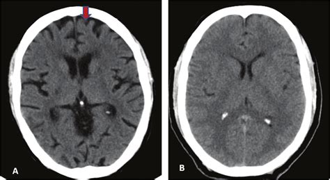 A Case And B Control Frontal Lobe Atrophy Present Red Arrow And