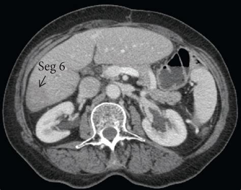 Patient 3 A B Colorectal Liver Metastasis With Right And Middle