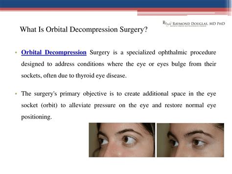 Ppt Understanding Orbital Decompression Surgery A Comprehensive
