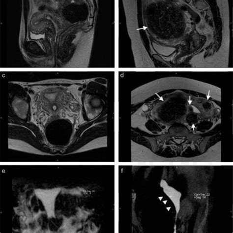 Sagittal And Axial T2 Weighted Images And Maximum Intensity Projection