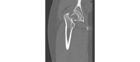 Ct Reconstruction Of Pathologic Fracture Of Femoral Neck Download Scientific Diagram