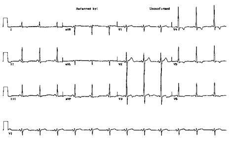 Lown Ganong Levine Syndrome