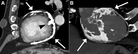 Myocardial Calcifications Pathophysiology Etiologies Differential Diagnoses And Imaging