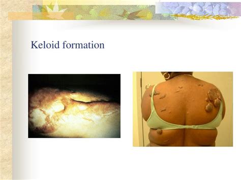Ppt Integumentary Burns Powerpoint Presentation Id337965