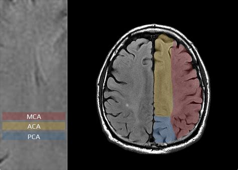 Anatomy Of Cerebral Arteries Stroke Manual